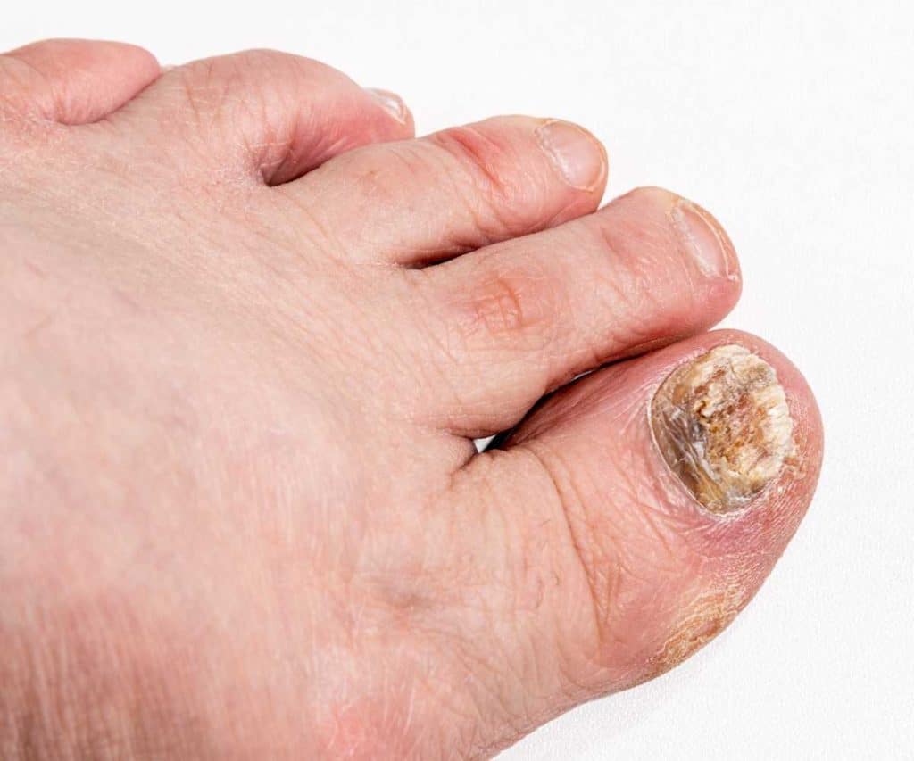 Mycose Ongle Pied Traitement Efficace Javel: Votre Solution Miracle à ...